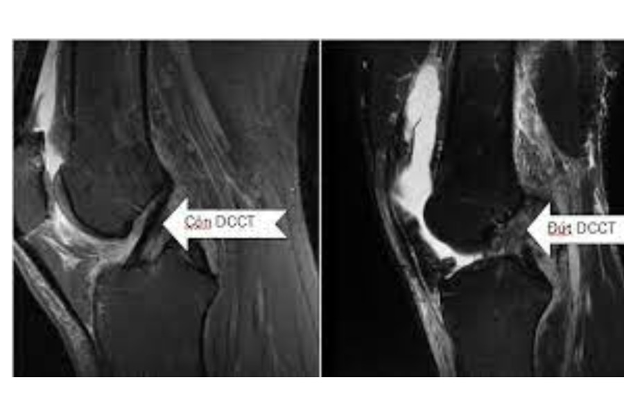 Hình Ảnh MRI Đứt Dây Chằng Chéo Trước: Tổng Quan Chuyên Sâu - Hành ...